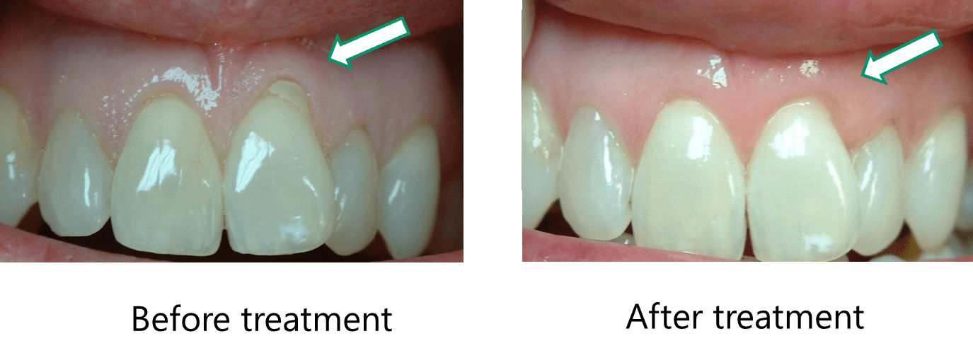 Gum Grafting - Burlington Family Dental Centre