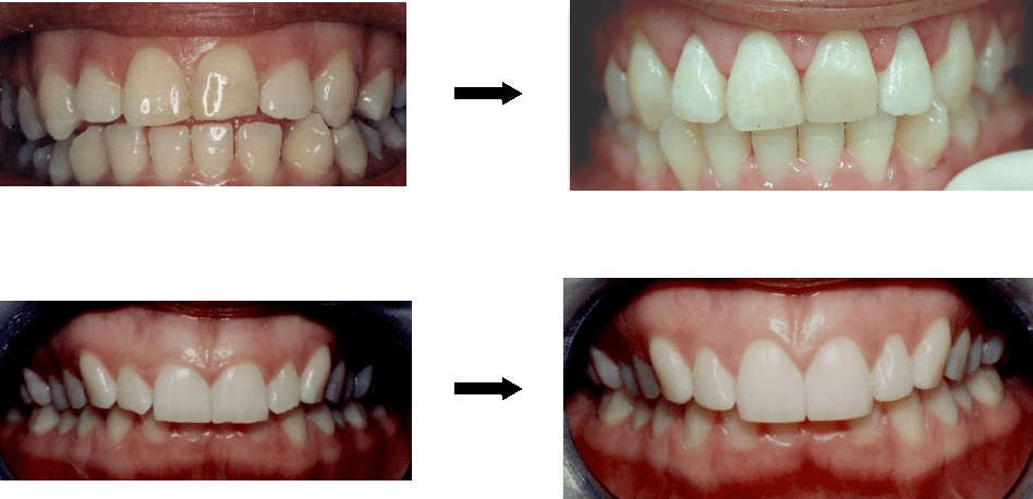 Gummy Smiles – Too Much Gum Visible? - Burlington Family Dental Centre